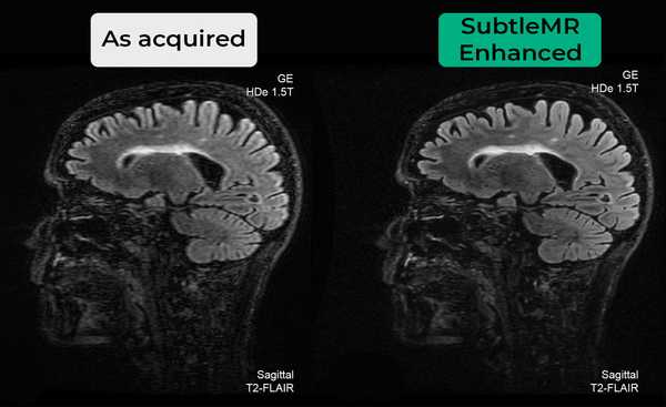 Subtle Medical | SubtlePET 90-day trial